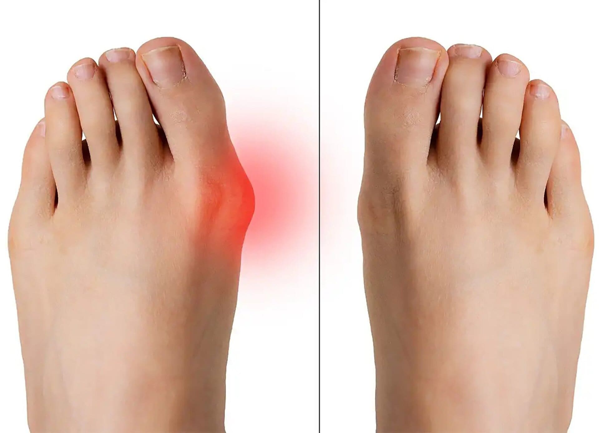Hallux Valgus (Bunion) Explained: Causes, Symptoms, and Effective ...