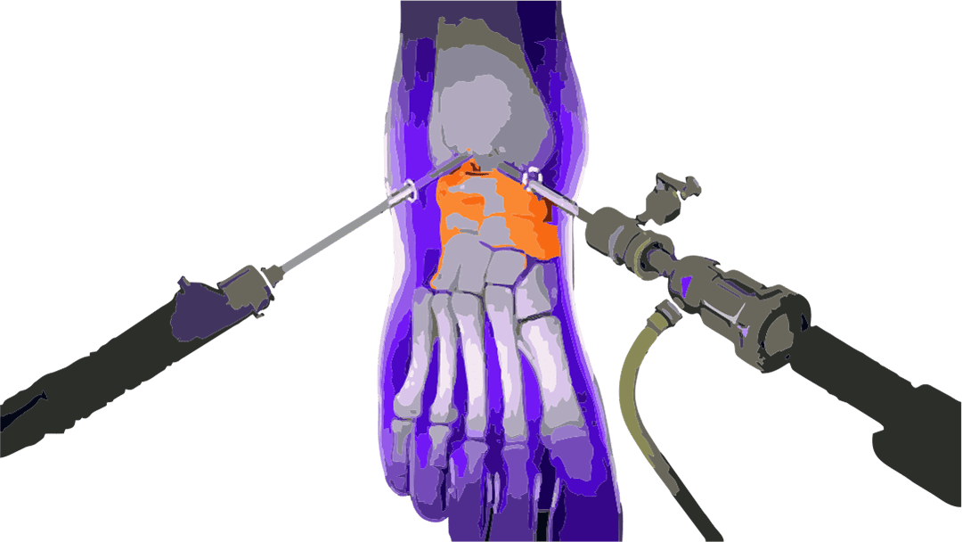 Foot & Ankle Arthroscopy – Nisantasi FootPlus Clinic