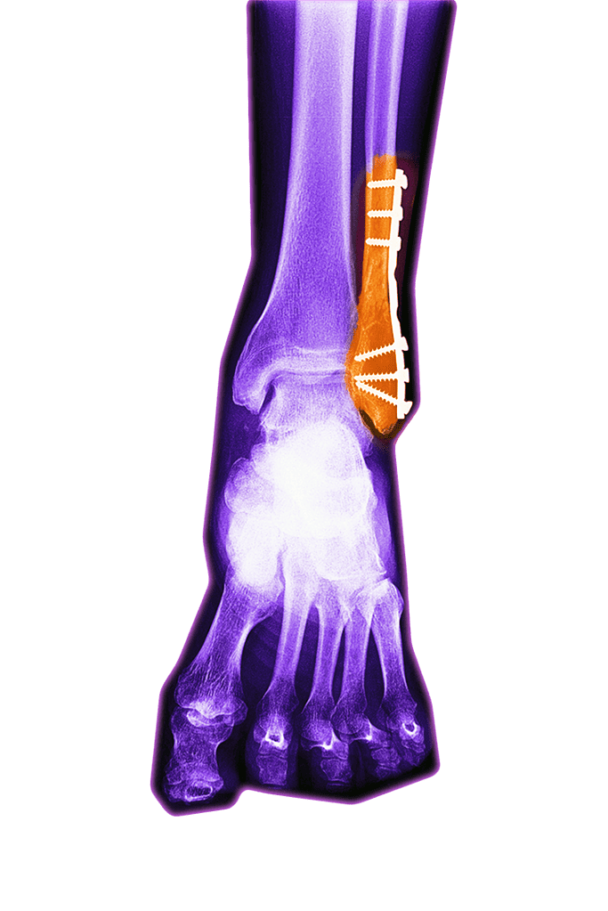 Foot And Ankle Fractures - - Nisantasi FootPlus Clinic - Treatments ...