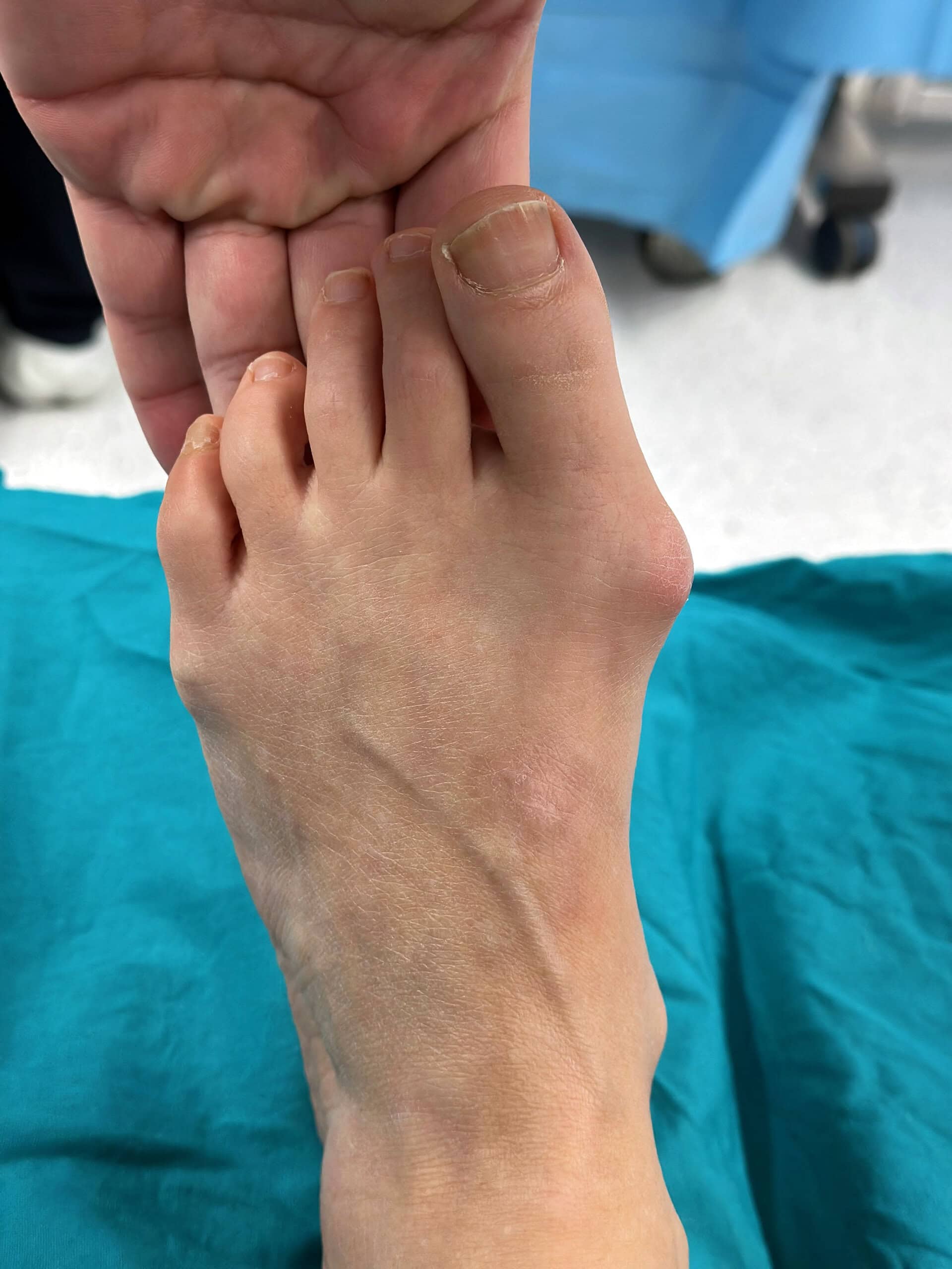 Hallux Valgus (Bunion) Explained: Causes, Symptoms, and Effective ...