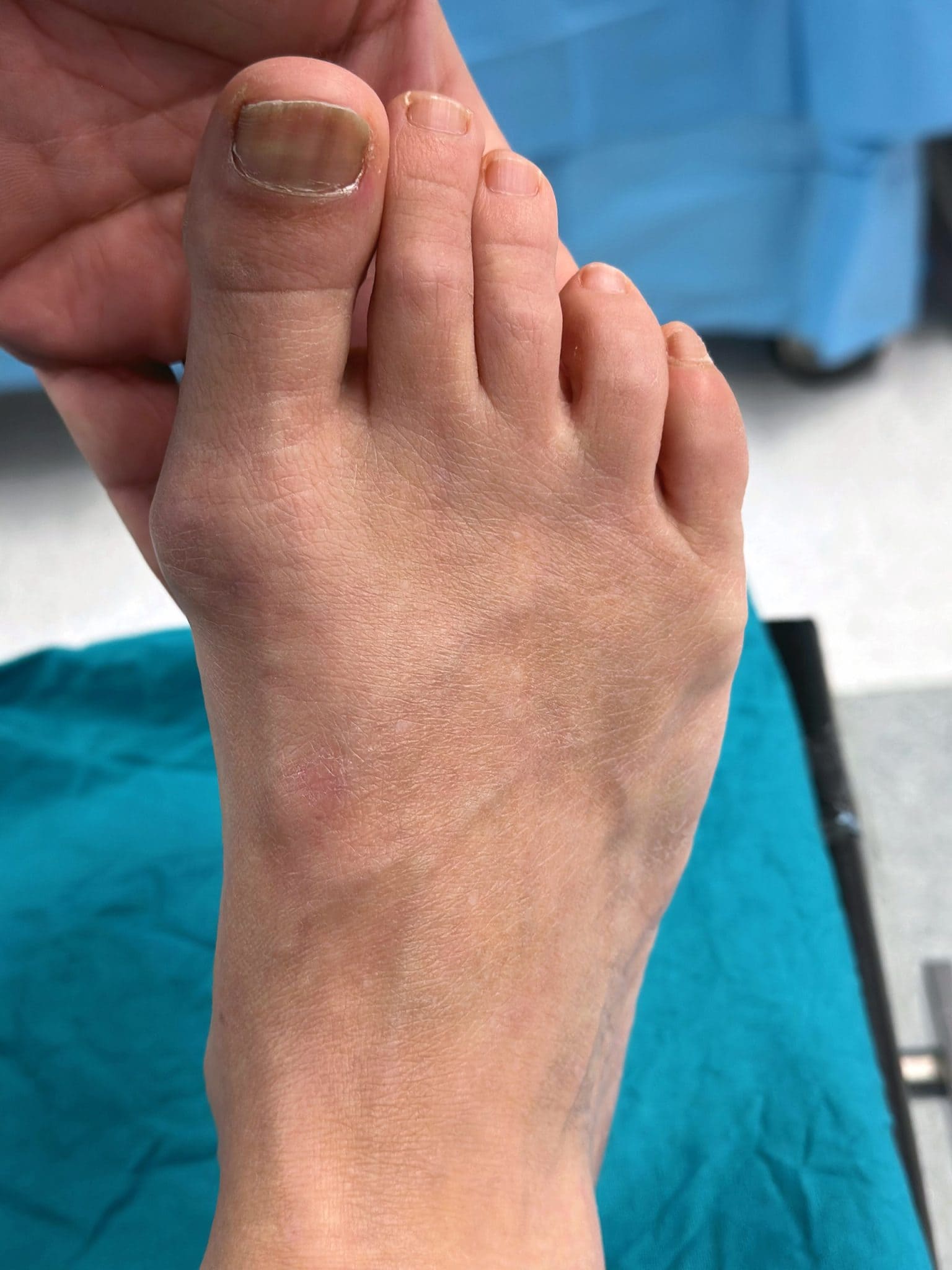 Hallux Valgus (Bunion) Explained: Causes, Symptoms, and Effective Treatments – Nisantasi ...