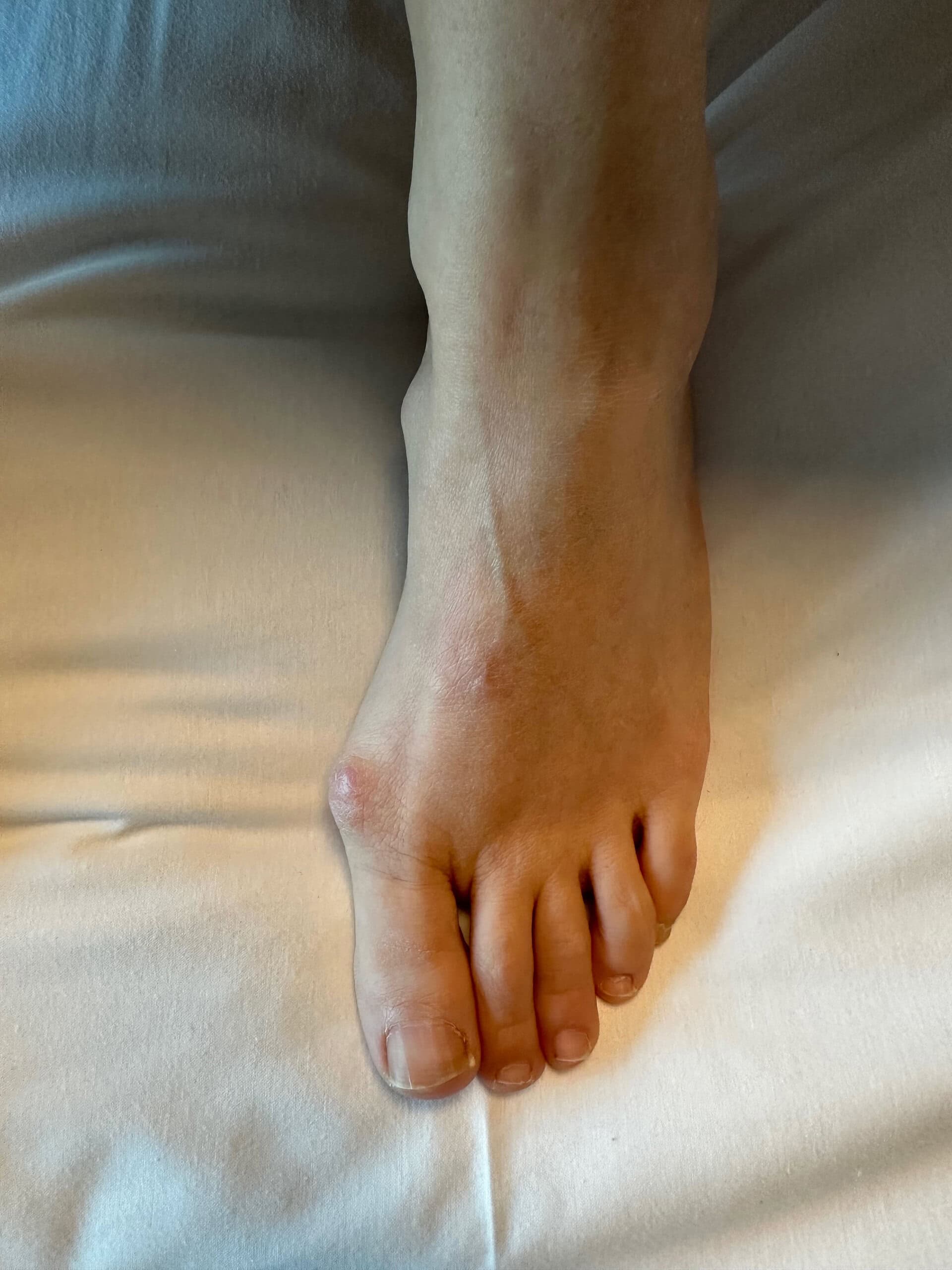Hallux Valgus (Bunion) Explained: Causes, Symptoms, and Effective ...