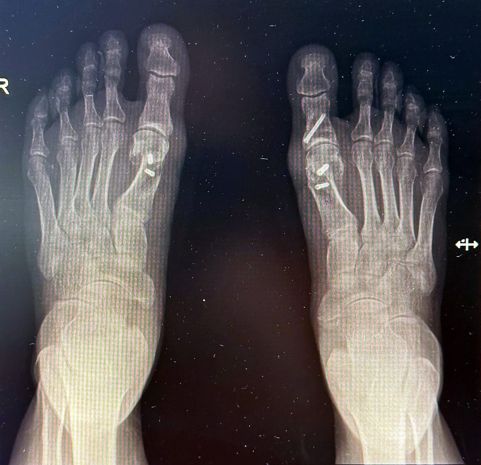 Hallux Valgus (Bunion) Explained: Causes, Symptoms, and Effective ...