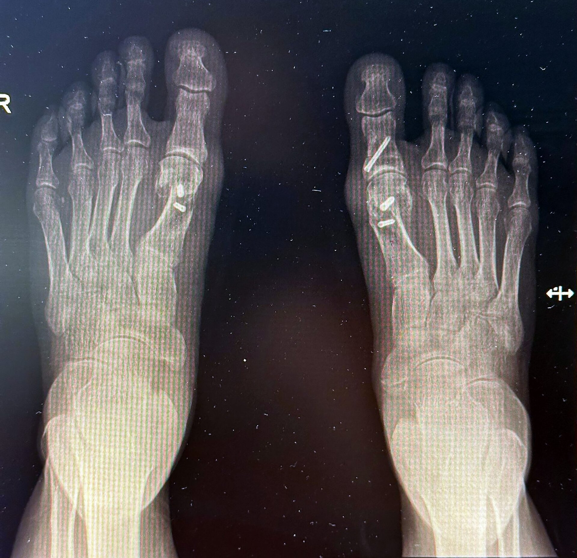 Hallux Valgus (Bunion) Explained: Causes, Symptoms, and Effective ...