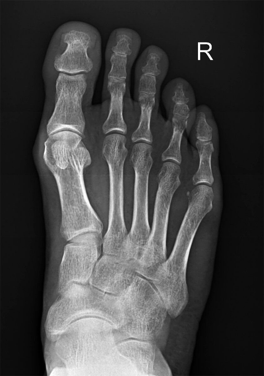 Hallux Valgus (Bunion) Explained: Causes, Symptoms, and Effective ...